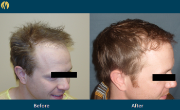 PRP & Laser Hair Treatment Results | HRI of Minnesota Clinic
