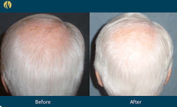 PRP & Laser Hair Treatment Results | HRI of Minnesota Clinic