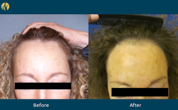 PRP & Laser Hair Treatment Results | HRI of Minnesota Clinic