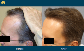 Results Gallery: PRP Laser Hair Treatment - HRI Minnesota