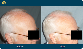 Results Gallery: PRP Laser Hair Treatment - HRI Minnesota