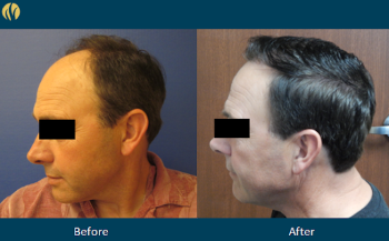 PRP & Laser Hair Treatment Results | HRI of Minnesota Clinic