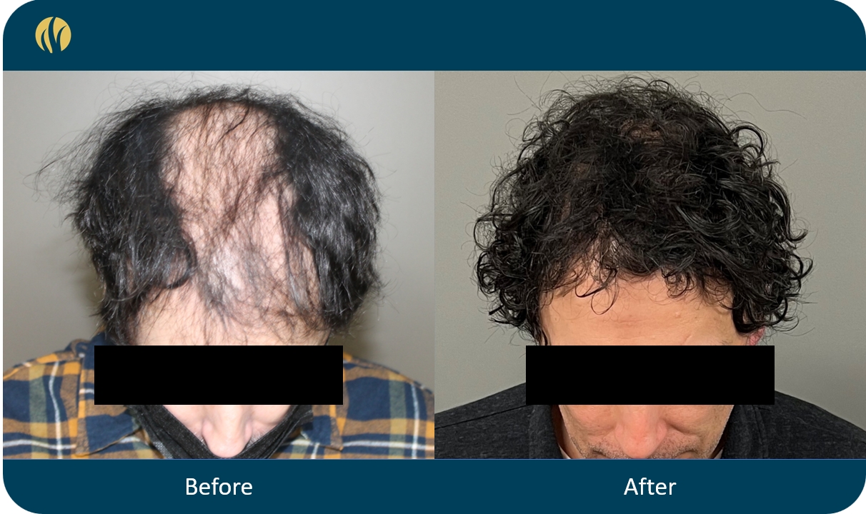 Hair Transplant Photo Gallery - HRI Minneapolis, Minnesota